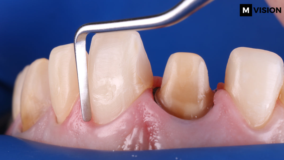 Enamel chisel (NM2) – Freshdental E-Store